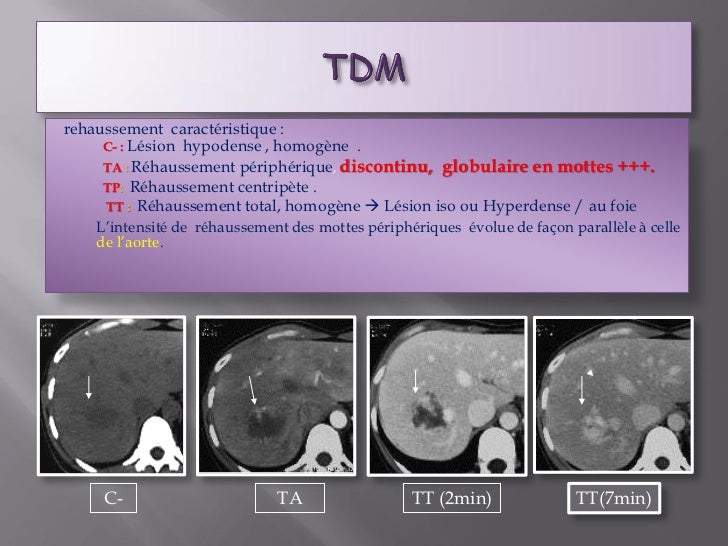 Angiomes hépatiques
