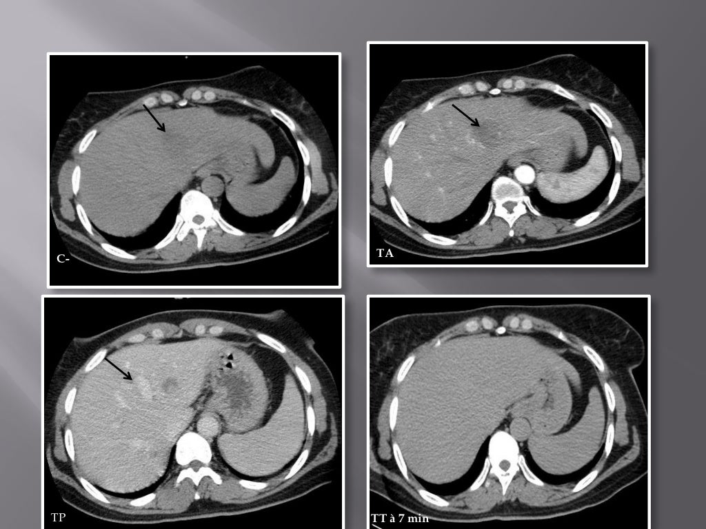 Angiomes hépatiques