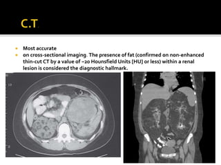 Angiomyolipoma | PPT