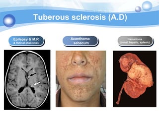 Ain-shams University,Urology department, ,Angiomyolipoma, by Mahmoud ...