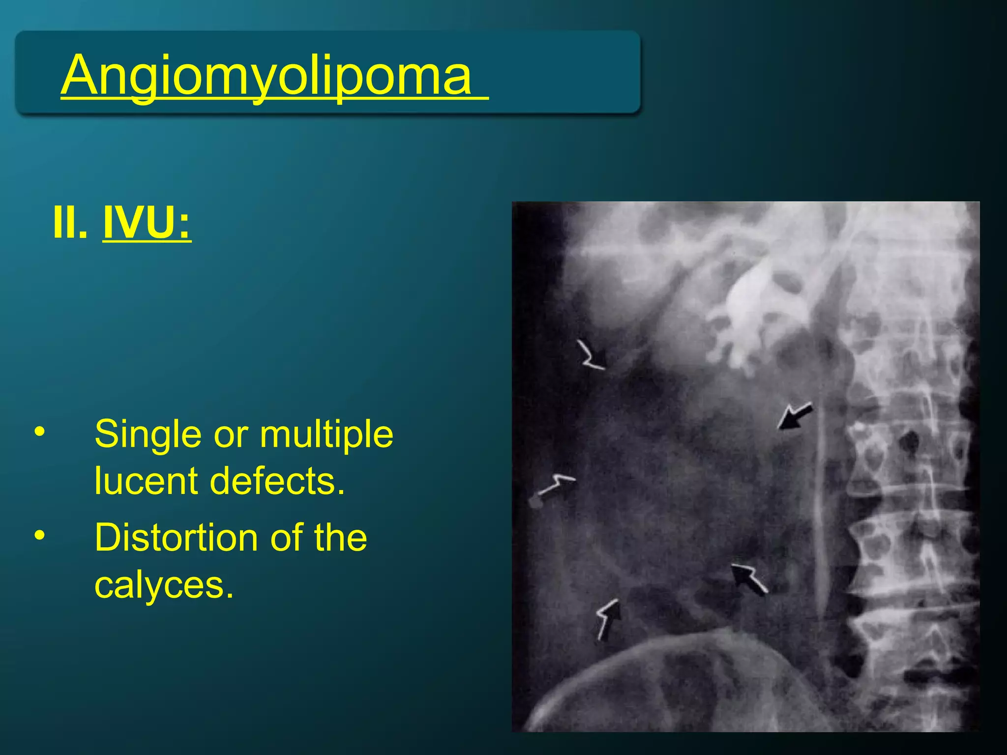 Angiomyolipoma | PPT
