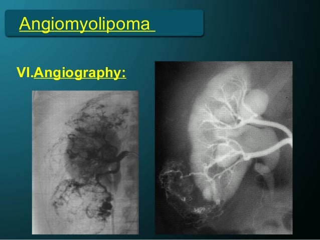 Angiomyolipoma