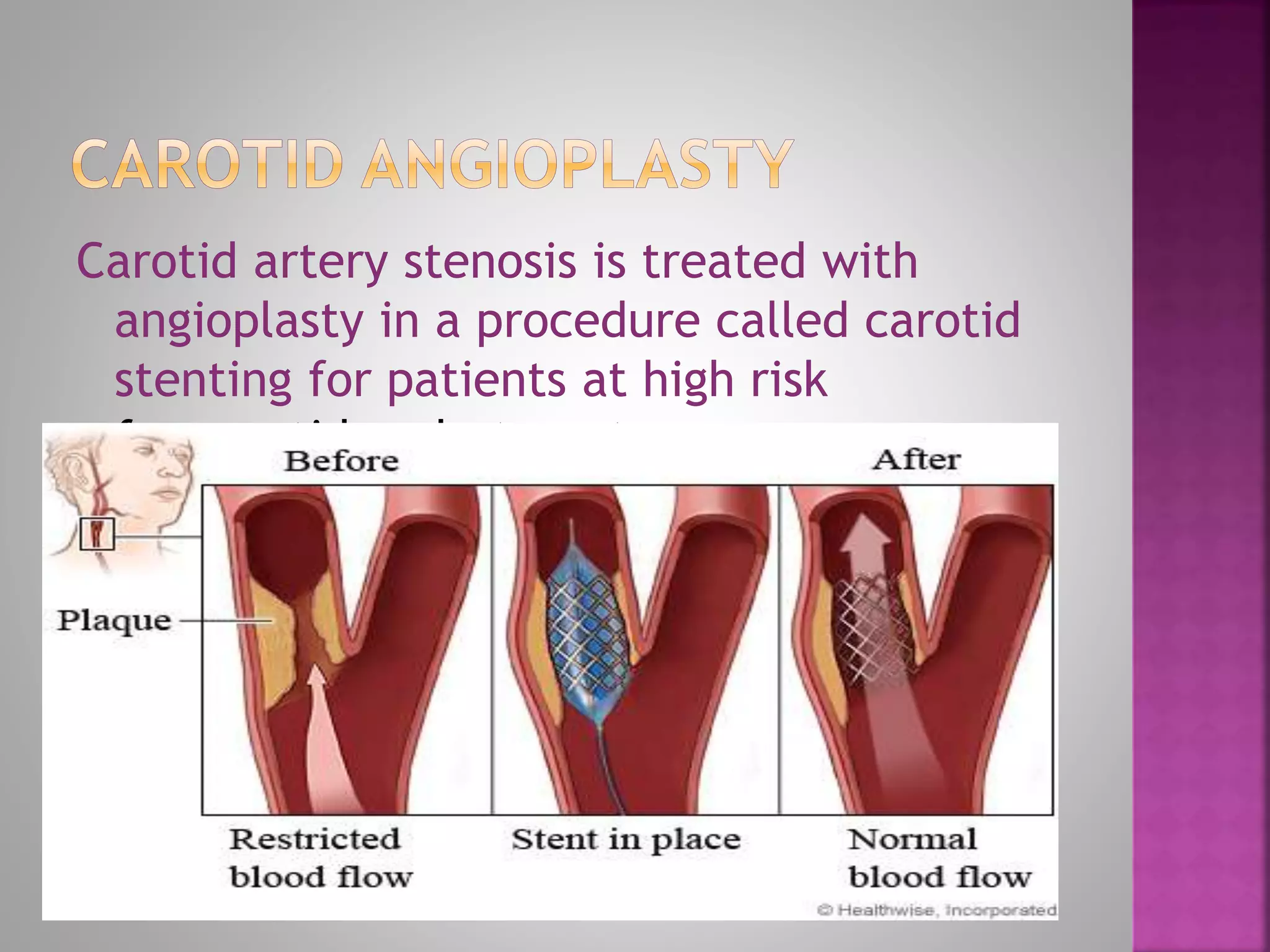 Angioplasty & Stents | PPTX