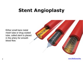 Facts on Angioplasty | PPT