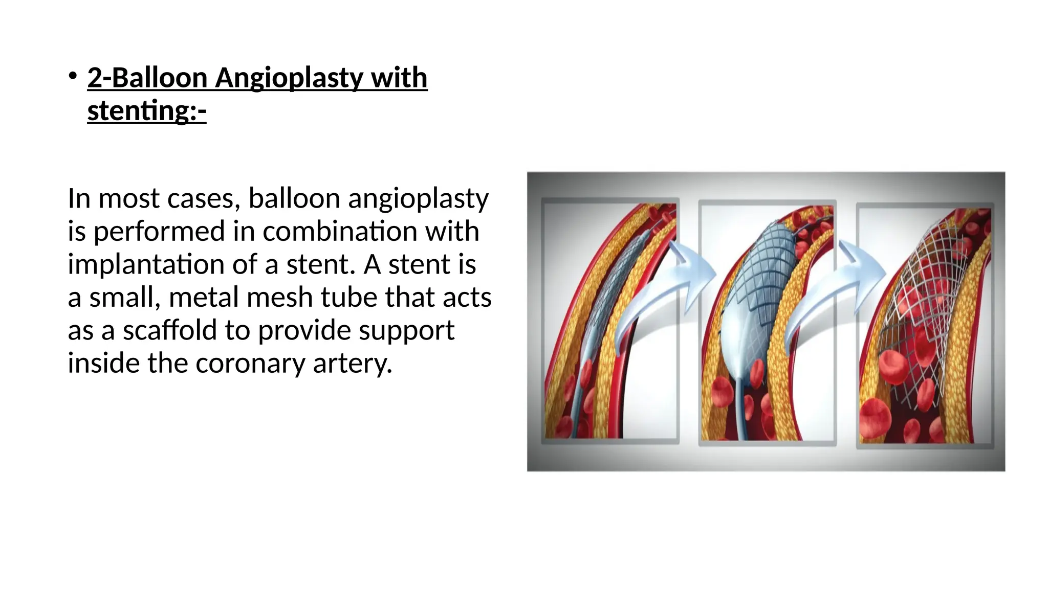 ANGIOPLASTY procedure a minimal invasive procedure ppt..pptx