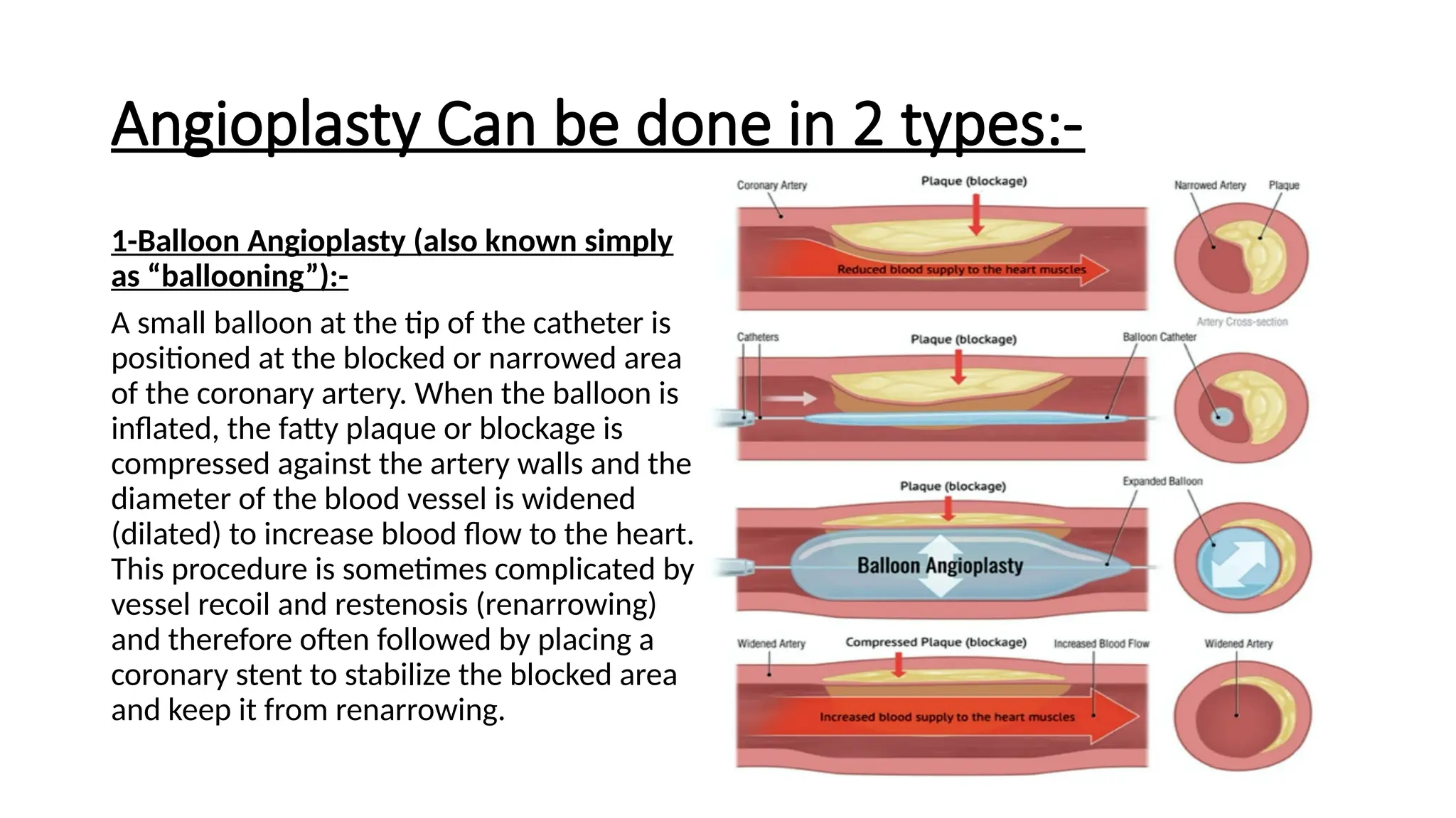 ANGIOPLASTY procedure a minimal invasive procedure ppt..pptx