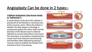 ANGIOPLASTY procedure a minimal invasive procedure ppt..pptx