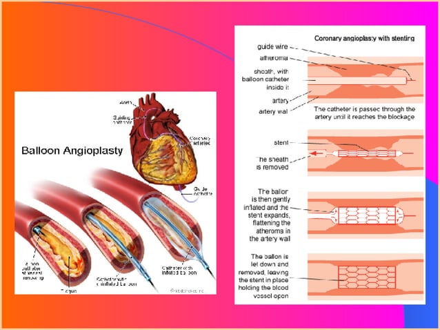 NurseReview.Org Angioplasty Vs. Bypass | PPT | Heart and Cardiovascular ...