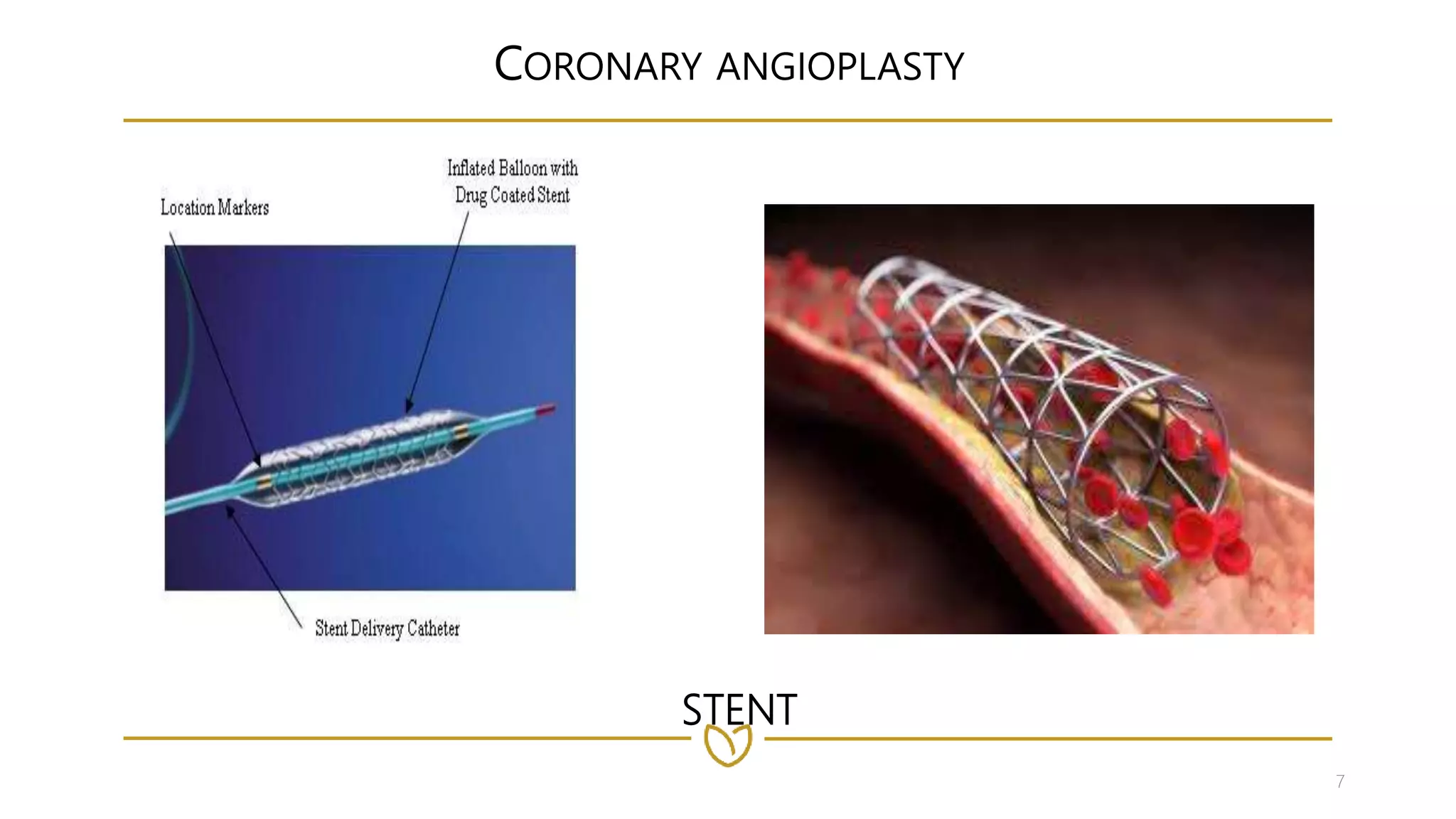 ANGIOPLASTY (1).pptx