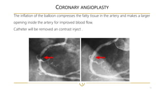 ANGIOPLASTY (1).pptx