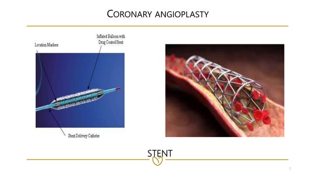 ANGIOPLASTY (1).pptx | First Aid | Injuries