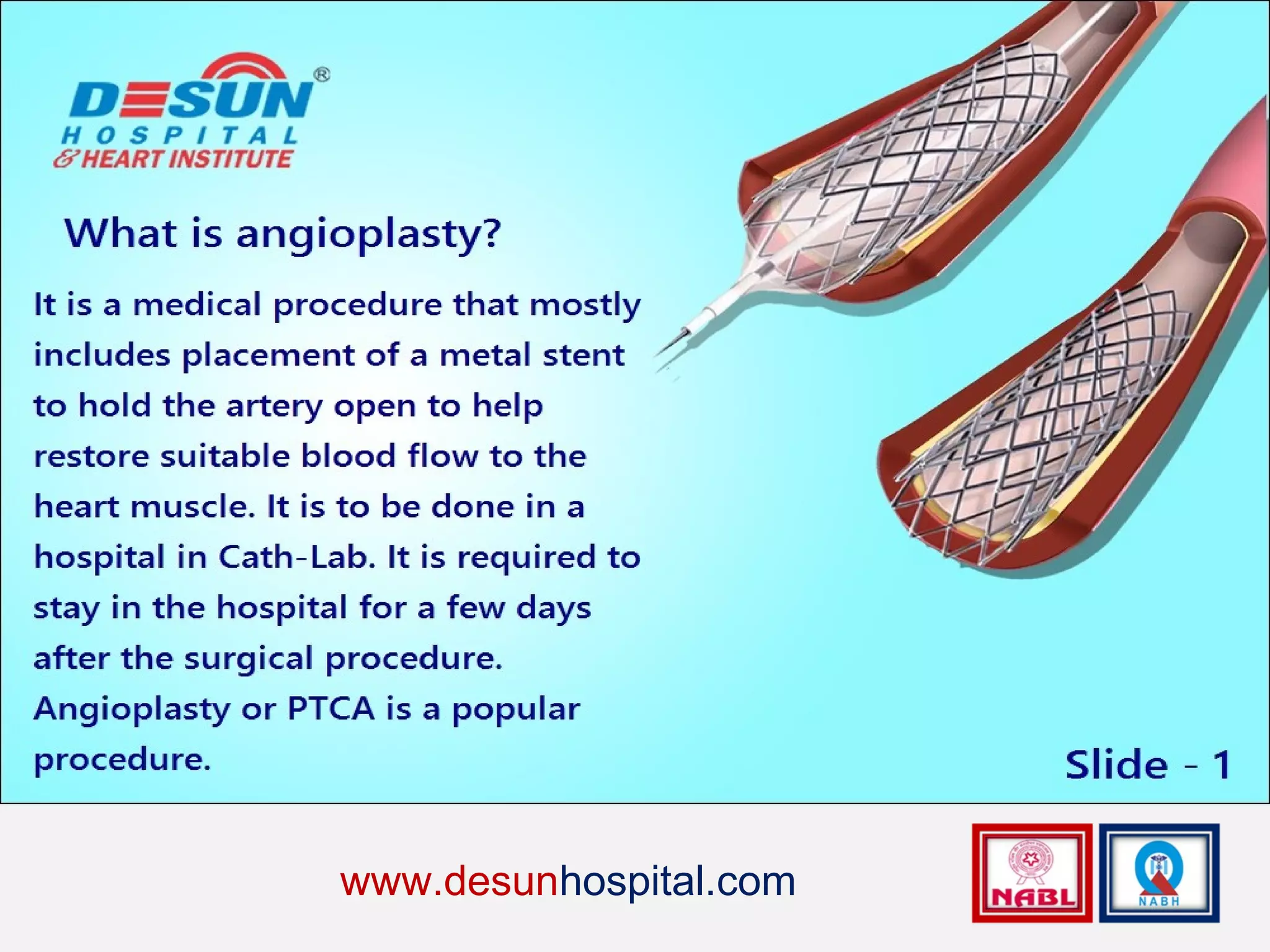 Angioplasty - PTCA - Facts for Patients - Desun Hospital Kolkata | PPT