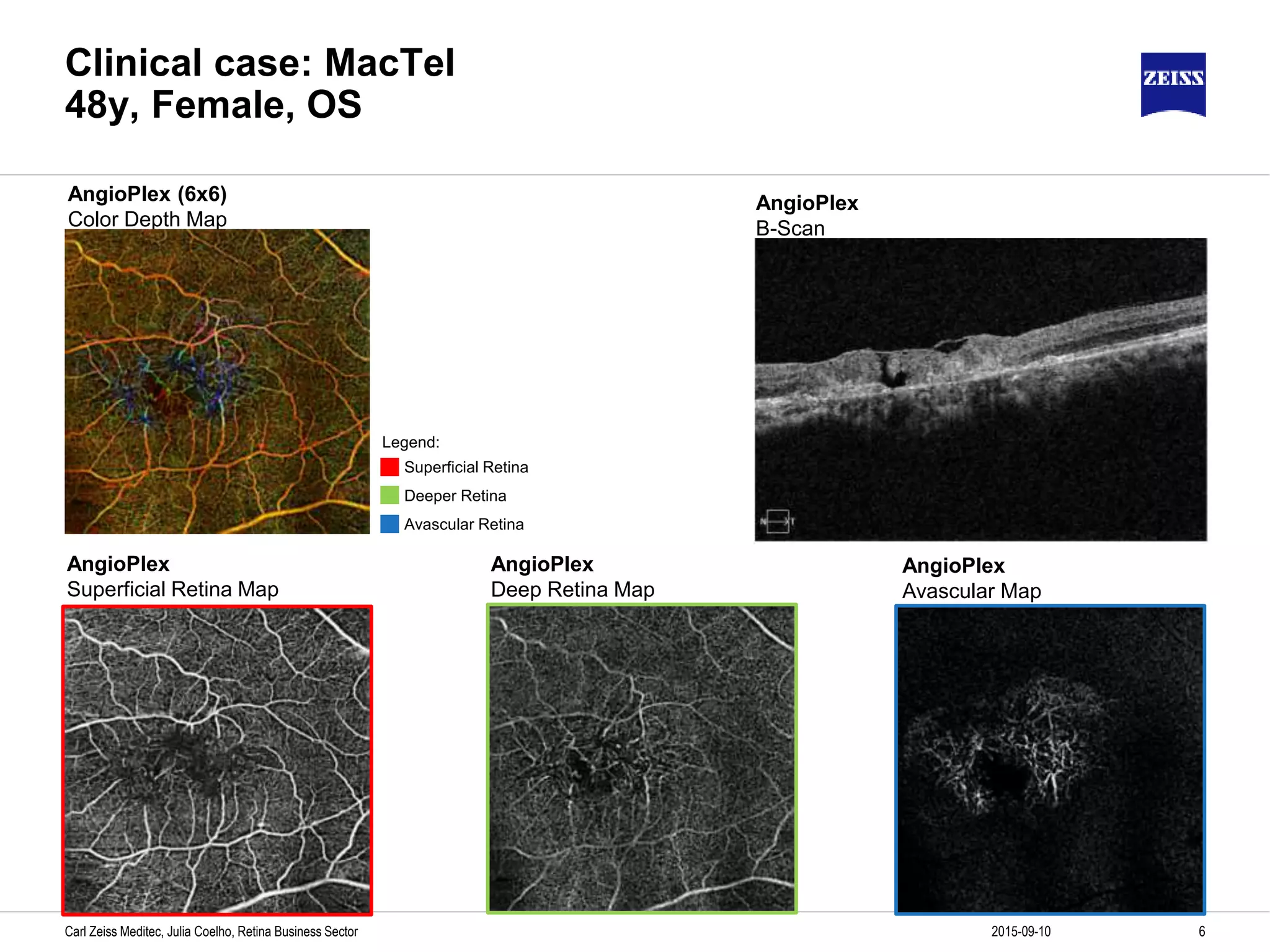 Angio plex clinical_cases OCTA | PPTX | Eye and Vision Conditions ...