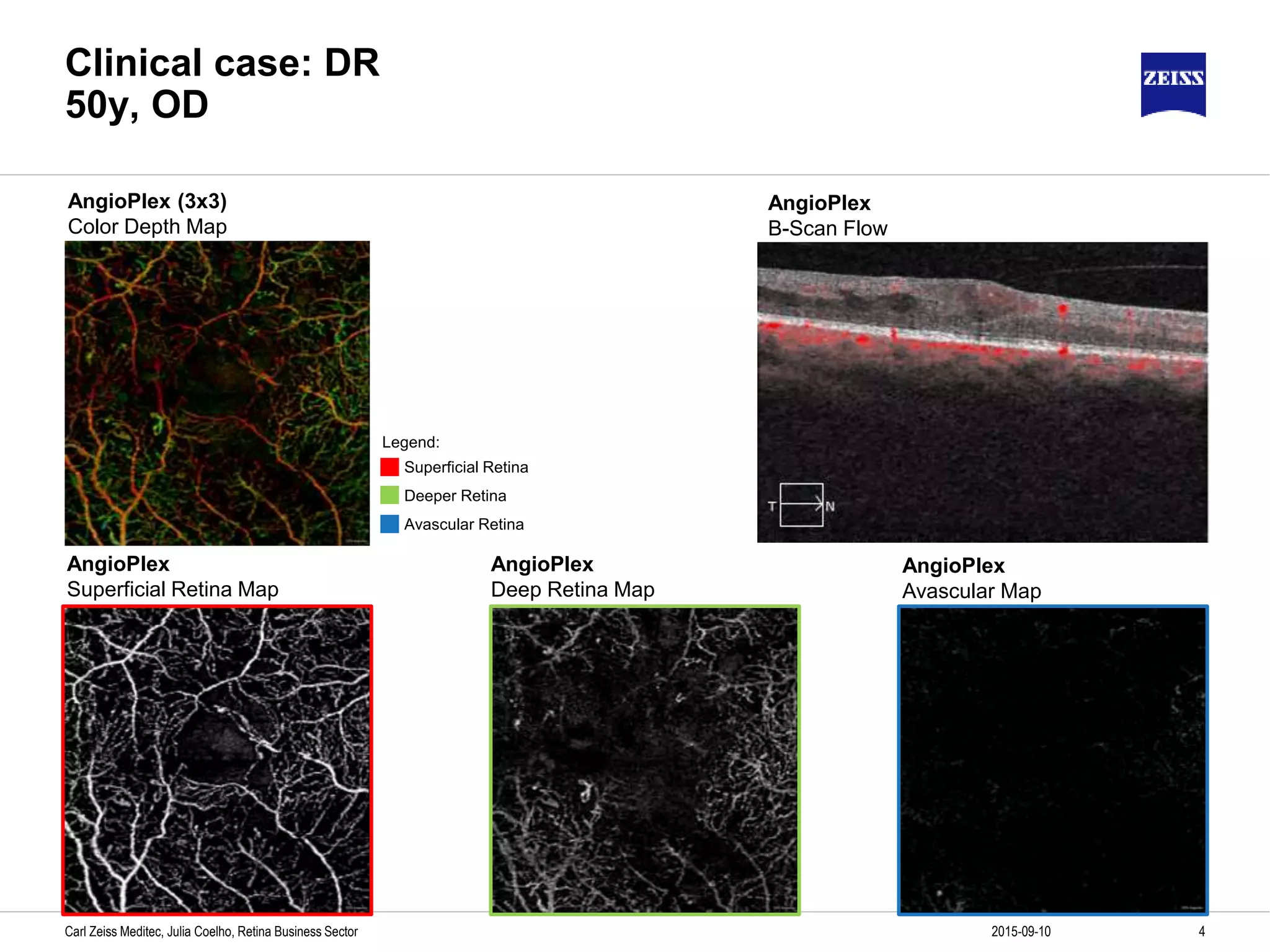Angio plex clinical_cases OCTA AJAY DUDANI | PPTX