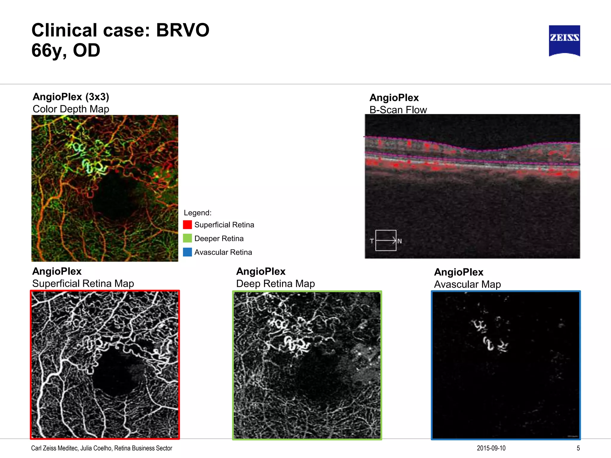 Angio plex clinical_cases OCTA AJAY DUDANI | PPTX