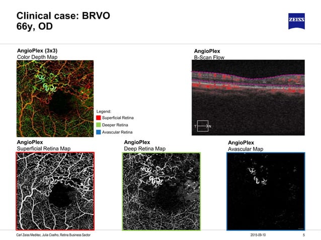 Angio plex clinical_cases OCTA AJAY DUDANI | PPTX