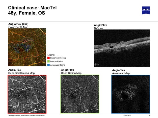 Angio plex clinical_cases OCTA AJAY DUDANI | PPTX