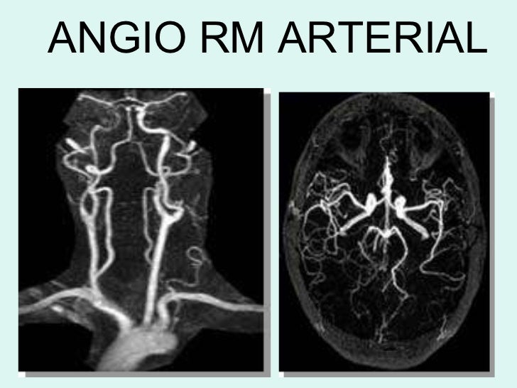 Angiotomografia