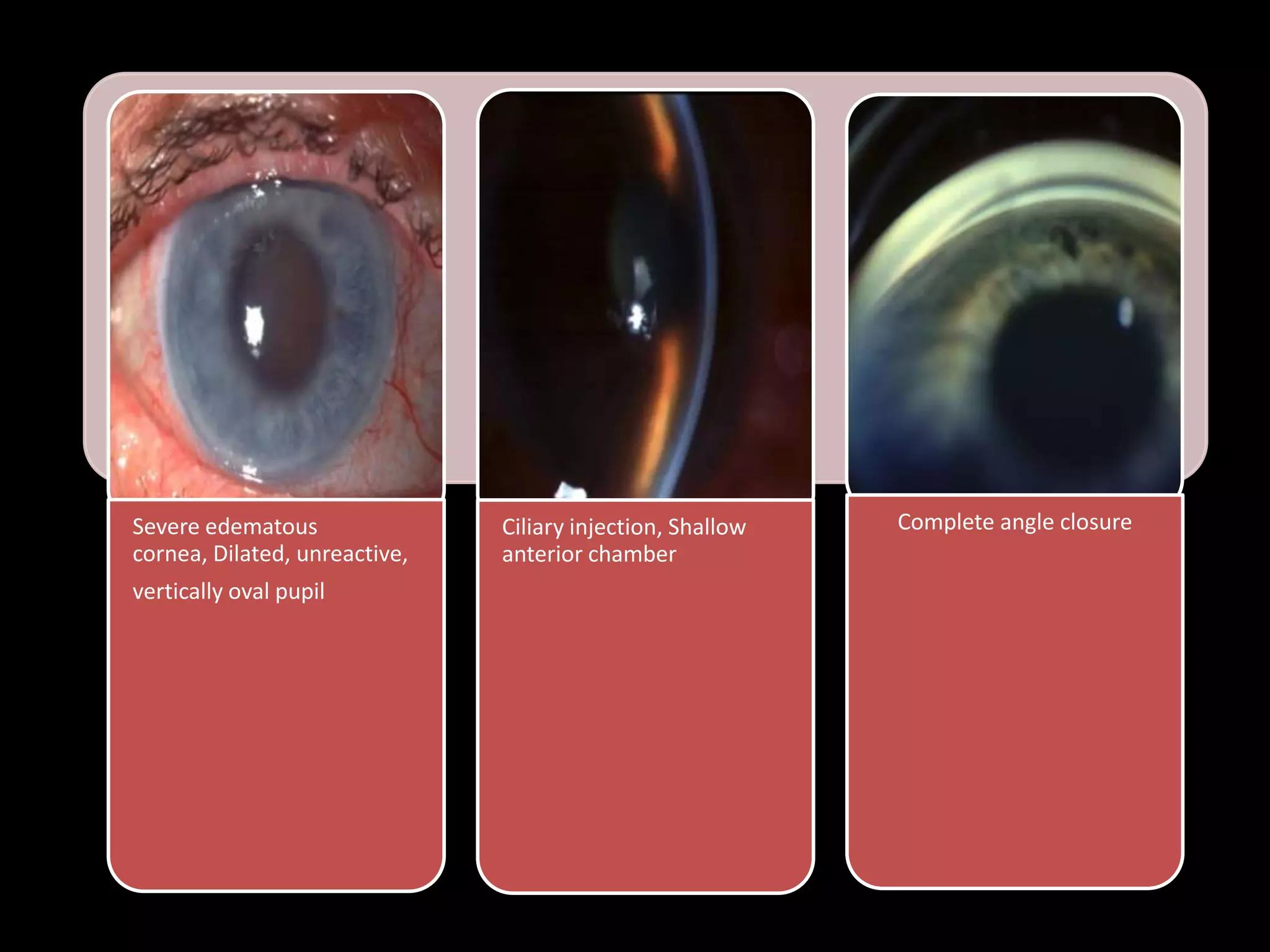 Angle closure-glaucoma-1259716832-phpapp01 | PPT