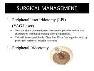 Angle Closure Glaucoma | PPTX