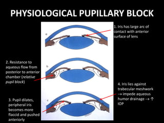 Angle Closure Glaucoma | PPTX