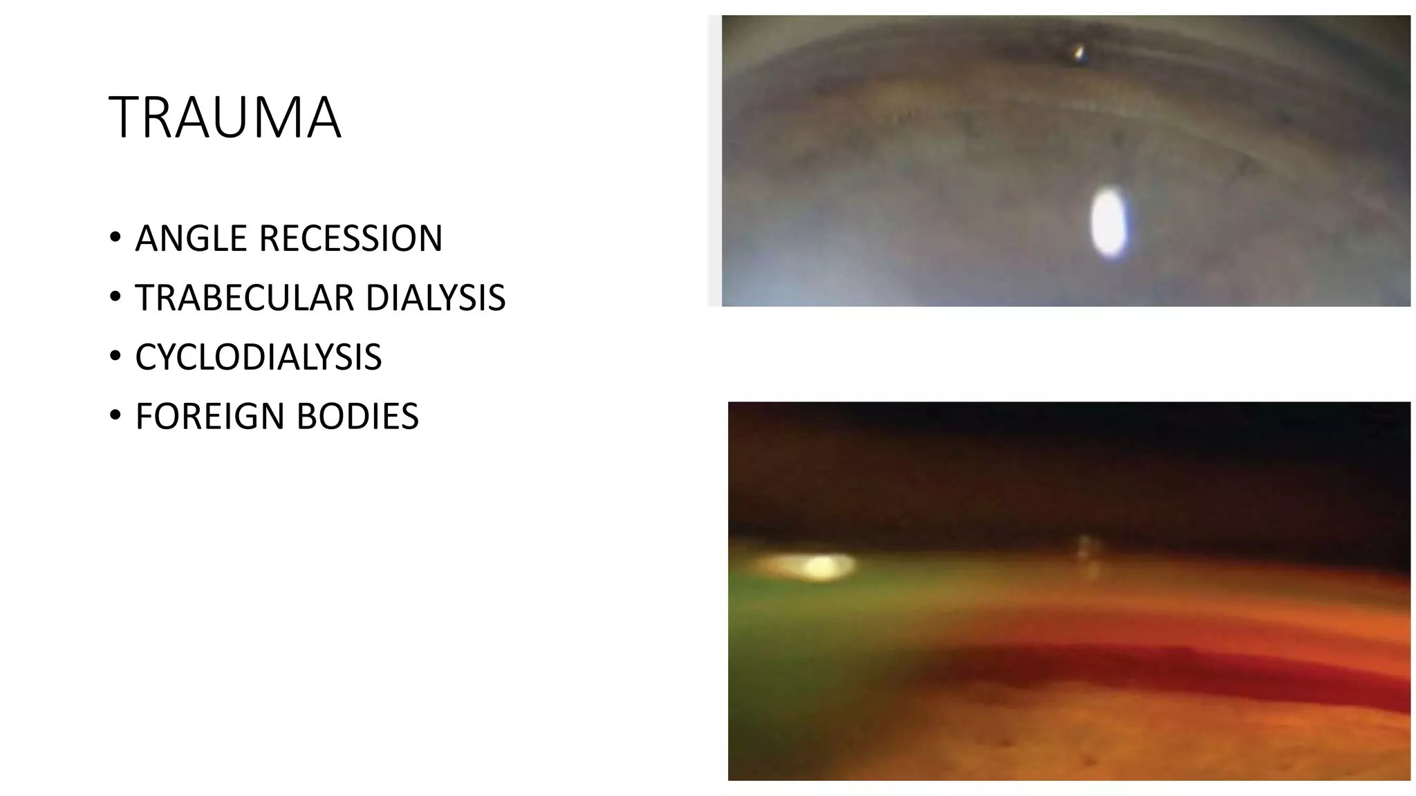 ANGLE ANATOMY | PPTX | Eye and Vision Conditions | Diseases and Conditions