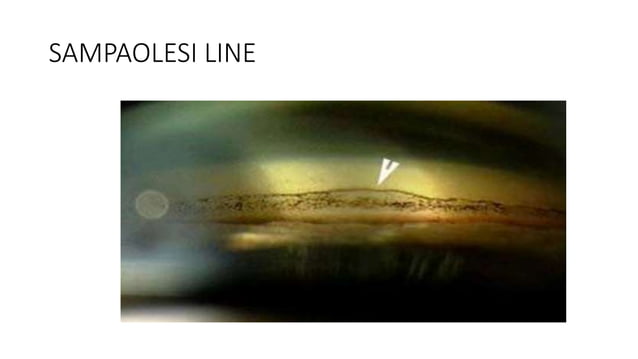ANGLE ANATOMY | PPTX | Eye and Vision Conditions | Diseases and Conditions
