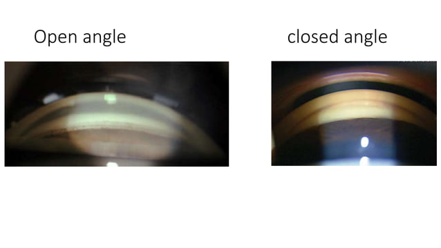 ANGLE ANATOMY | PPTX | Eye and Vision Conditions | Diseases and Conditions