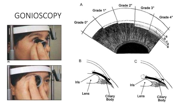 ANGLE ANATOMY | PPTX | Eye and Vision Conditions | Diseases and Conditions
