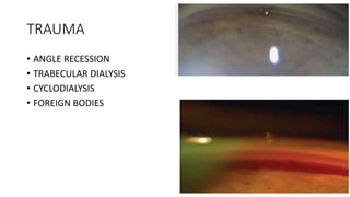 ANGLE ANATOMY | PPTX
