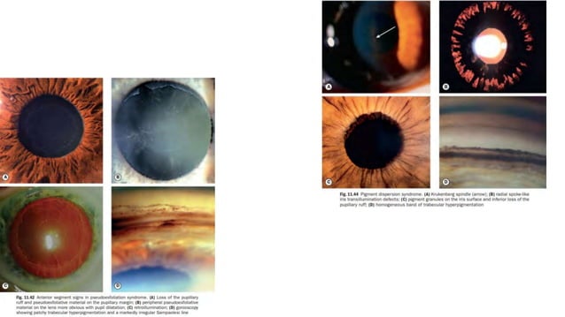 ANGLE ANATOMY | PPTX | Eye and Vision Conditions | Diseases and Conditions