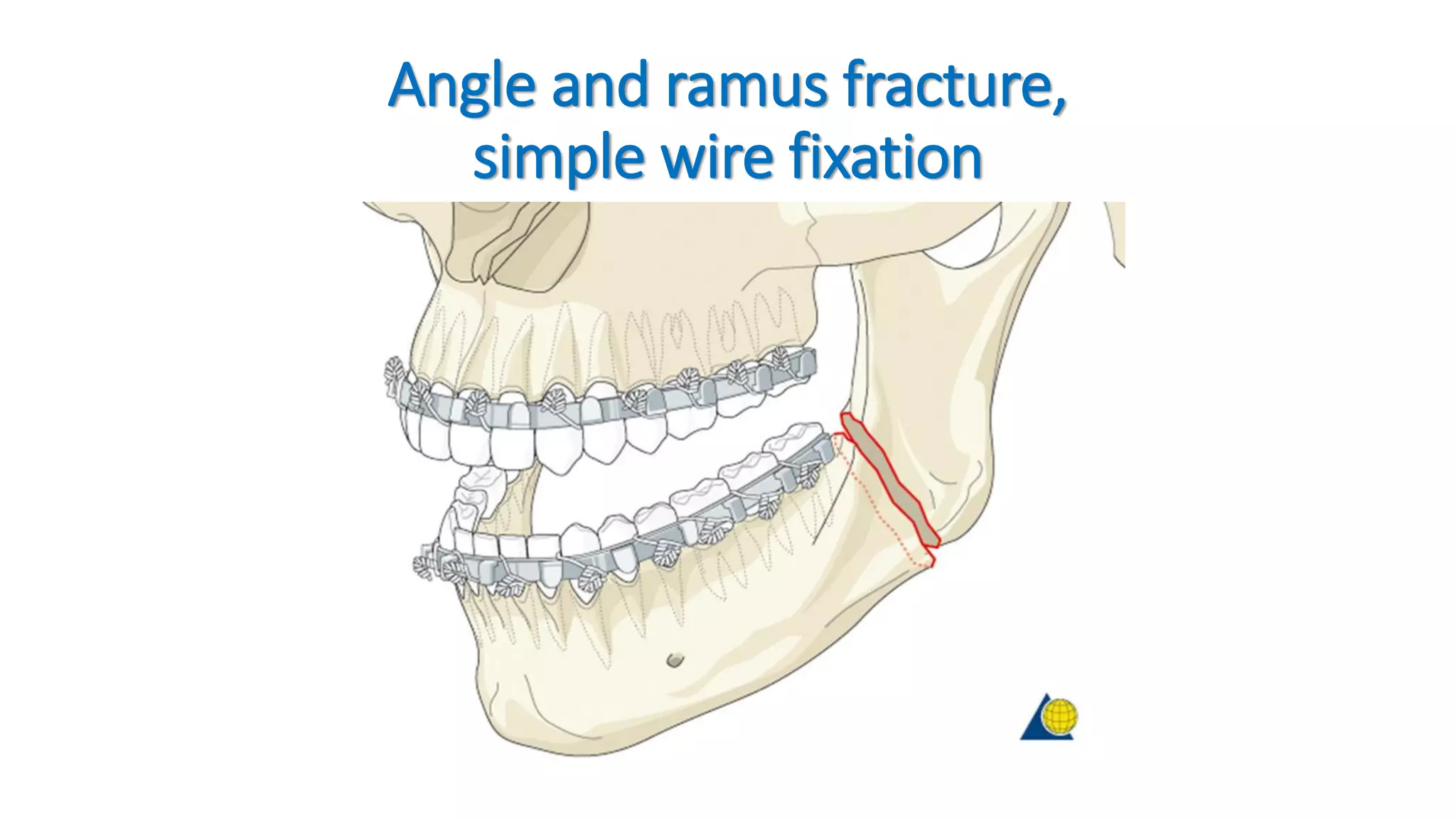 Angle and ramus fracture, simple | PPT
