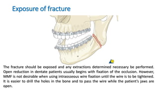Angle and ramus fracture, simple | PDF