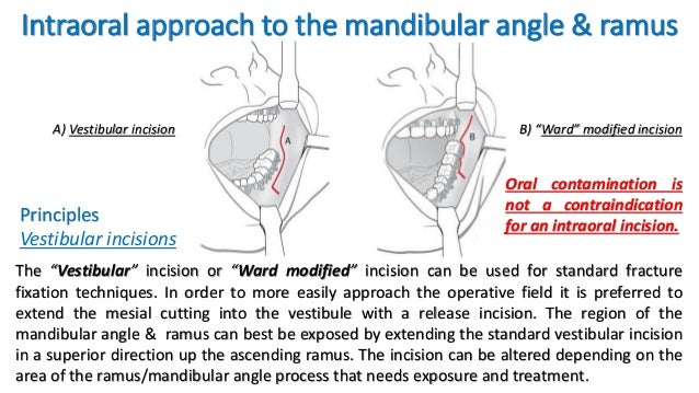 Angle and ramus fracture, simple