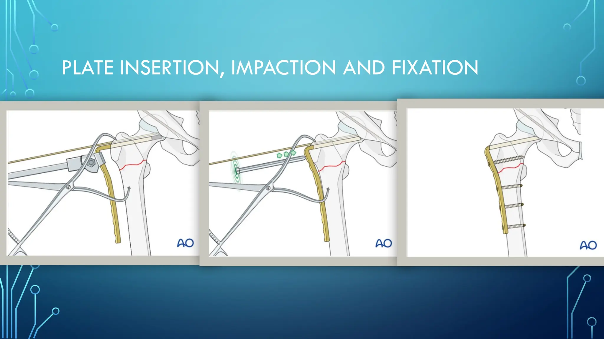 Angle blade plate[1] fracture of femur with - copy.pptx