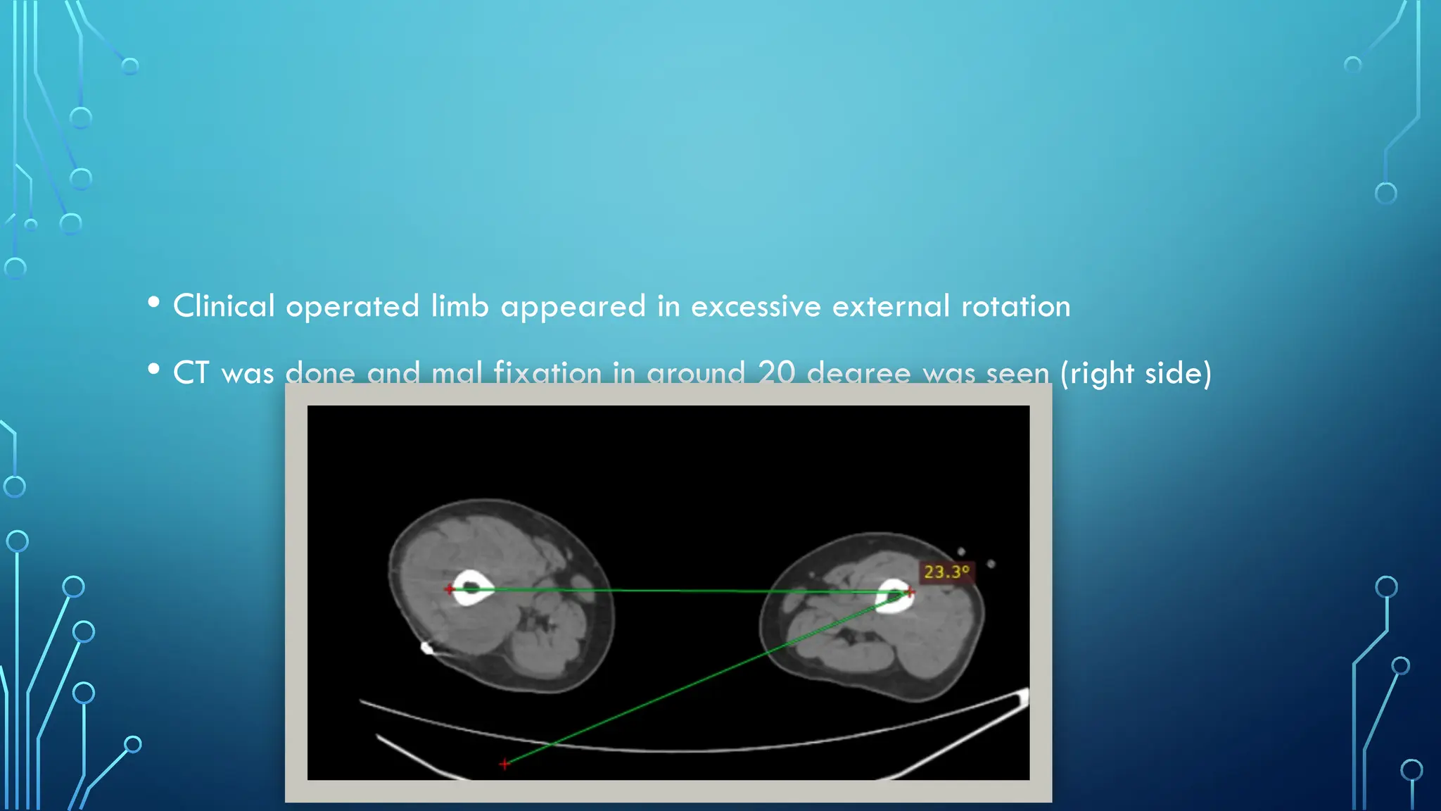 Angle blade plate[1] fracture of femur with - copy.pptx