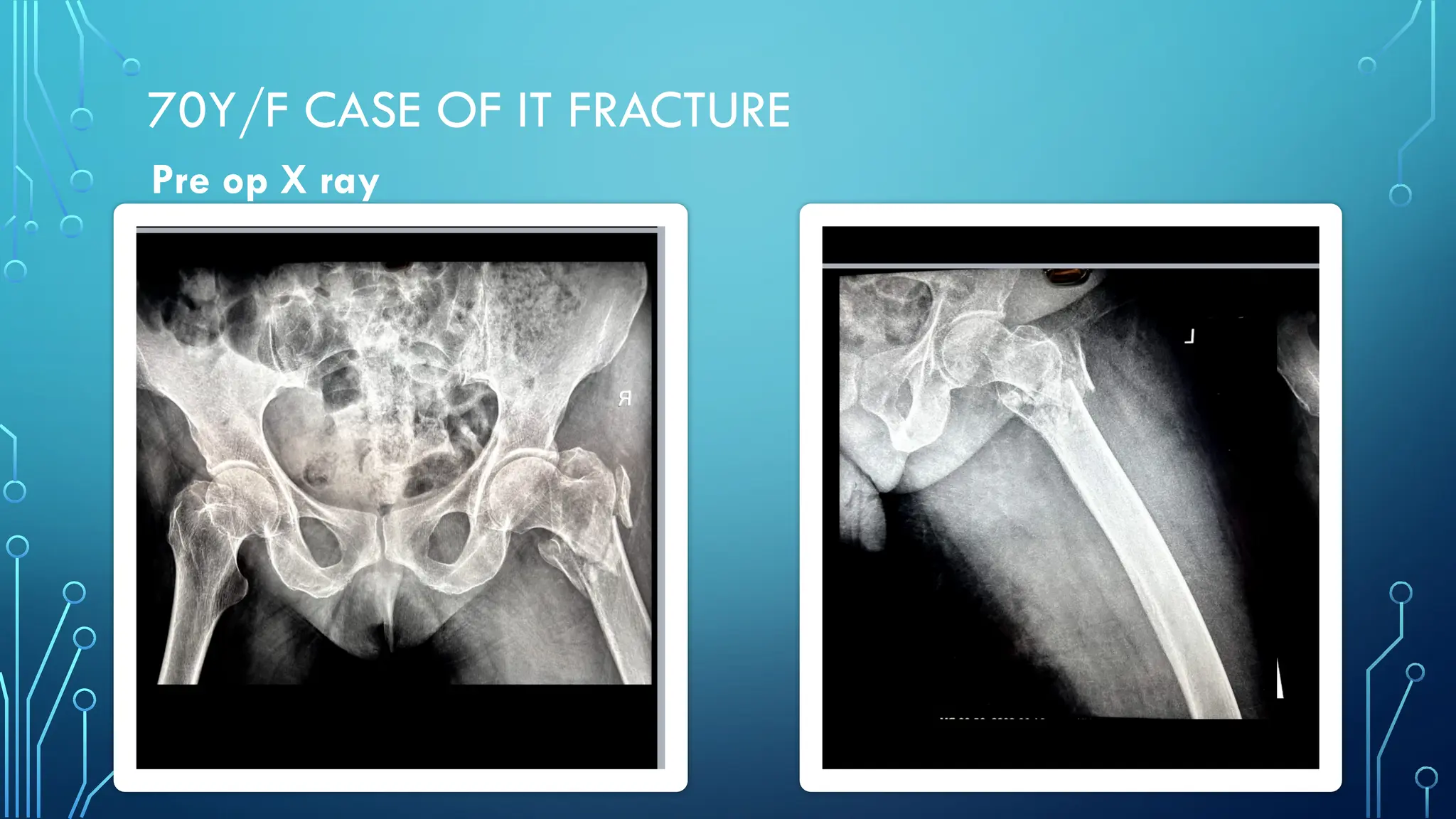Angle blade plate[1] fracture of femur with - copy.pptx