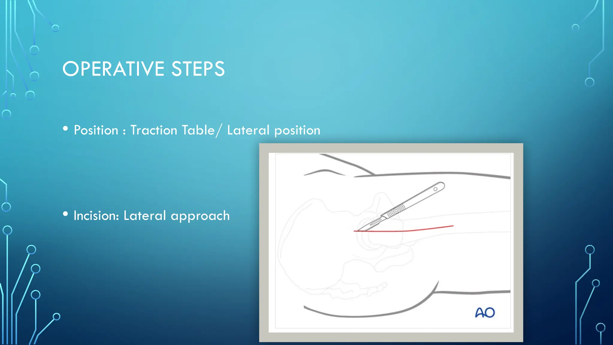 Angle blade plate[1] fracture of femur with - copy.pptx