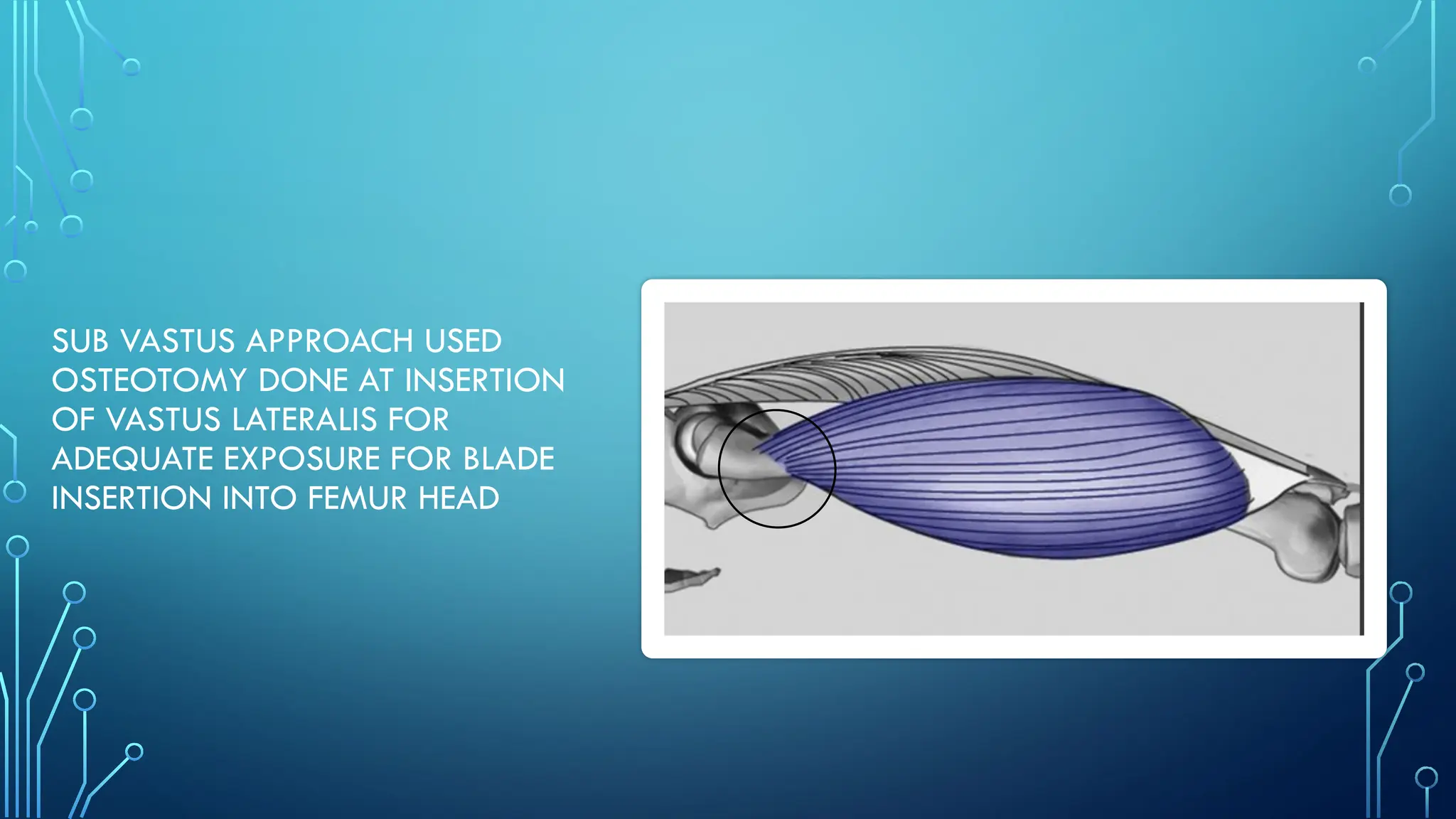 Angle blade plate[1] fracture of femur with - copy.pptx