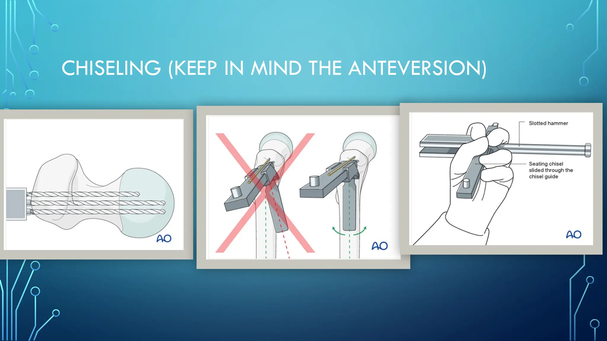 Angle blade plate[1] fracture of femur with - copy.pptx