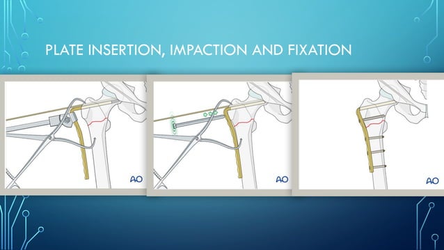Angle blade plate[1] fracture of femur with - copy.pptx | Death, Injury ...