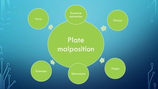 Angle blade plate[1] fracture of femur with - copy.pptx