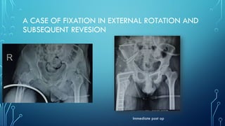Angle blade plate[1] fracture of femur with - copy.pptx