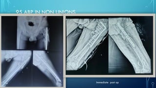 Angle blade plate[1] fracture of femur with - copy.pptx