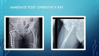 Angle blade plate[1] fracture of femur with - copy.pptx