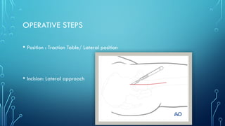 Angle blade plate[1] fracture of femur with - copy.pptx