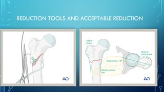 Angle blade plate[1] fracture of femur with - copy.pptx