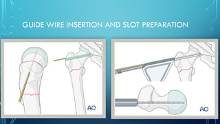 Angle blade plate[1] fracture of femur with - copy.pptx