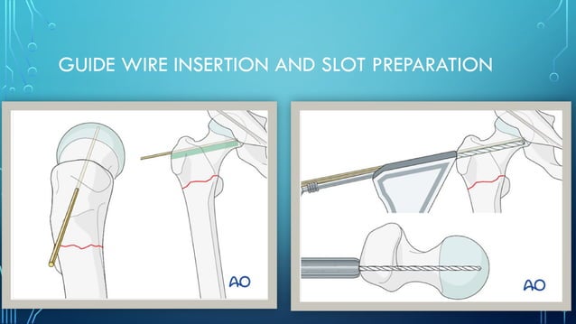 Angle blade plate[1] fracture of femur with - copy.pptx | Death, Injury ...