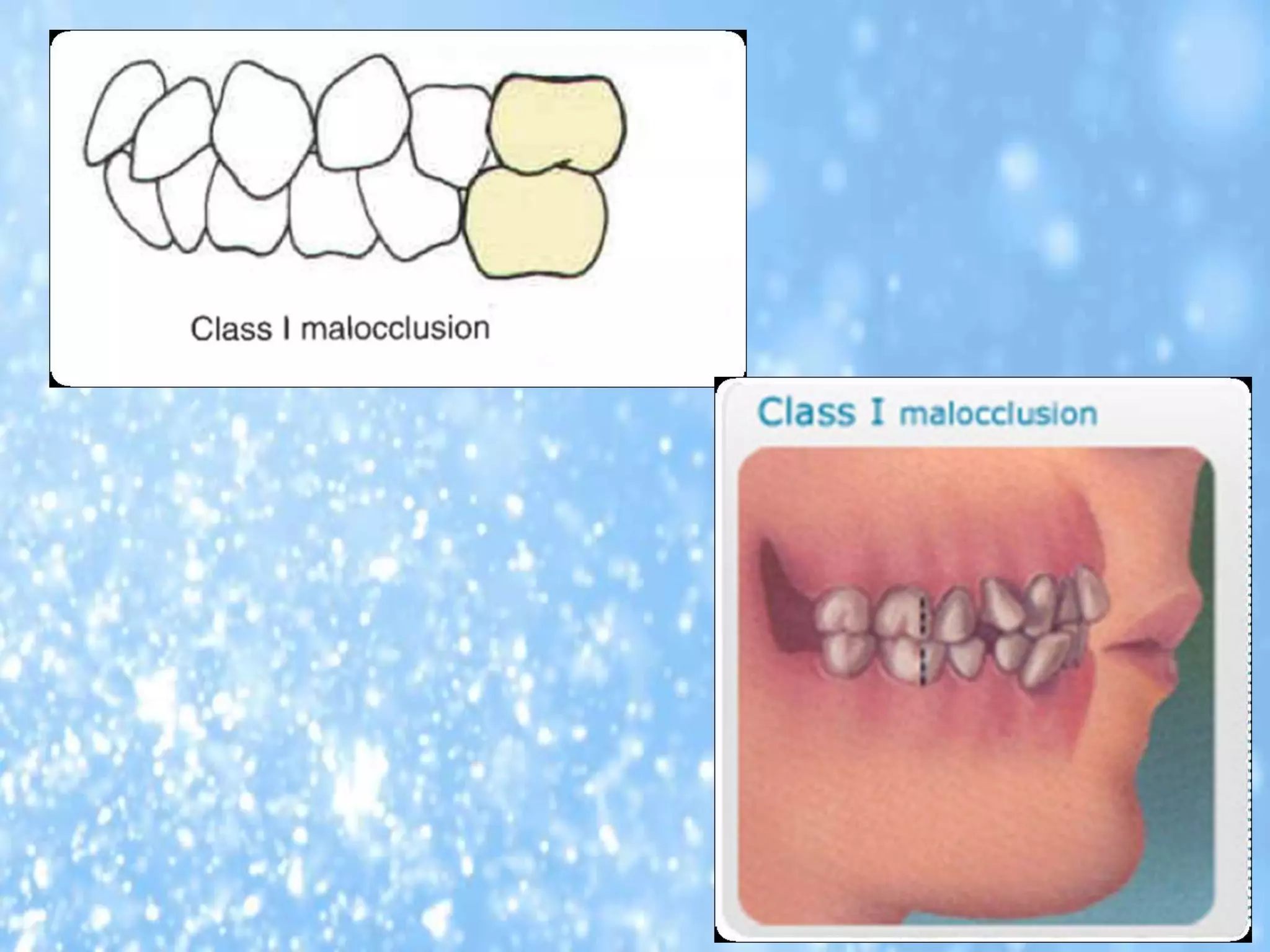 ANGLE'S CLASSIFICATION OF MALOCCLUSION | PPTX